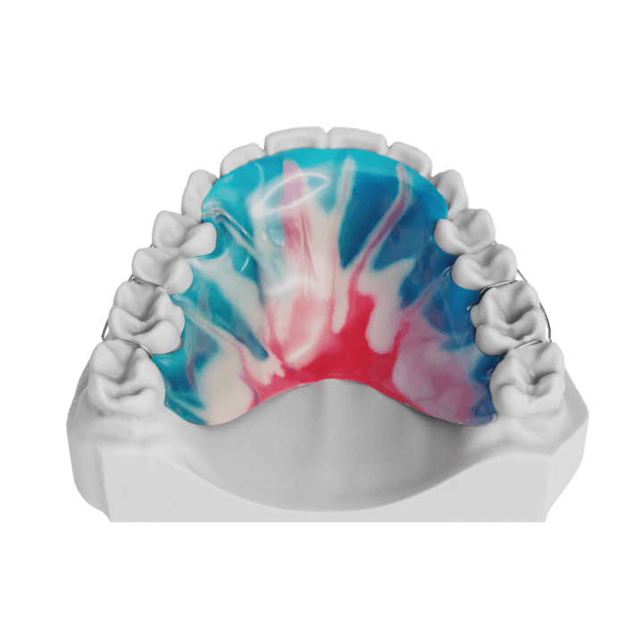 Hawley Retainers & Phase 1 | ODL Orthodontic Labs