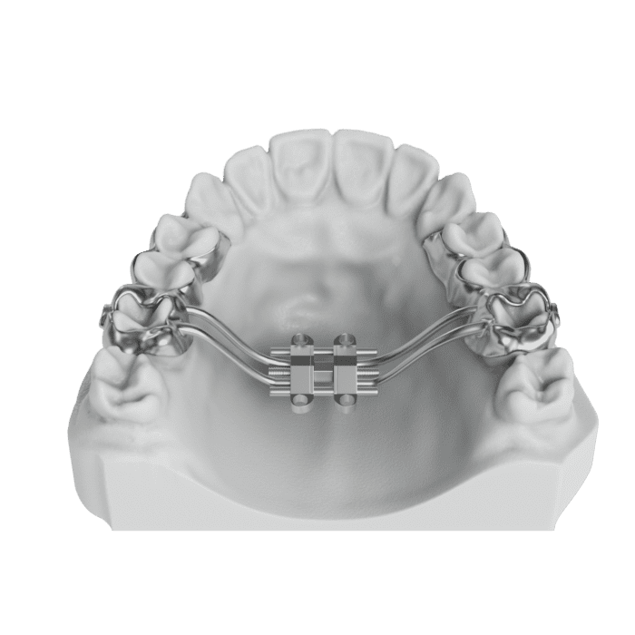TAD Appliances for Airway Expansion | ODL Orthodontic Labs