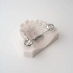 Compact RPE (Rapid Palatal Expander) | ODL Orthodontic Labs