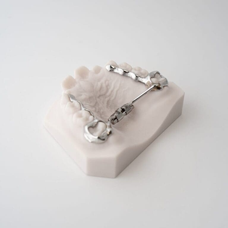 Compact RPE (Rapid Palatal Expander) | ODL Orthodontic Labs