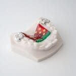 HAAS Expander | ODL Orthodontic Labs