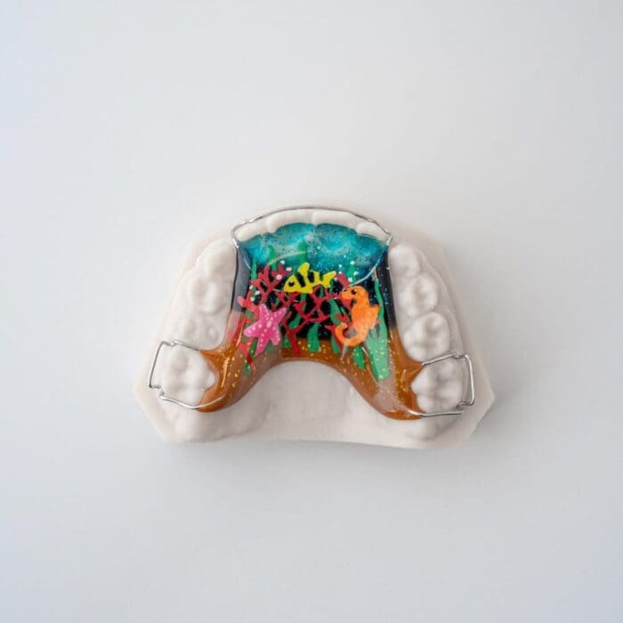 Hawley Phase 1 Retainer | ODL Orthodontic Labs