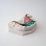 Hawley Phase 1 Retainer | ODL Orthodontic Labs