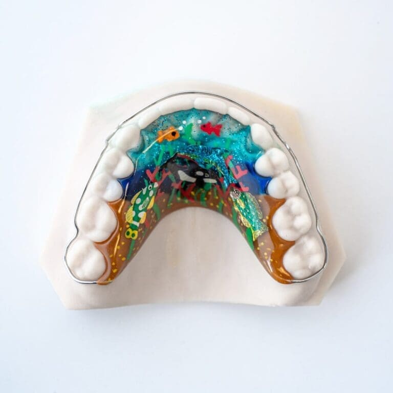 Hawley Wraparound | ODL Orthodontic Labs