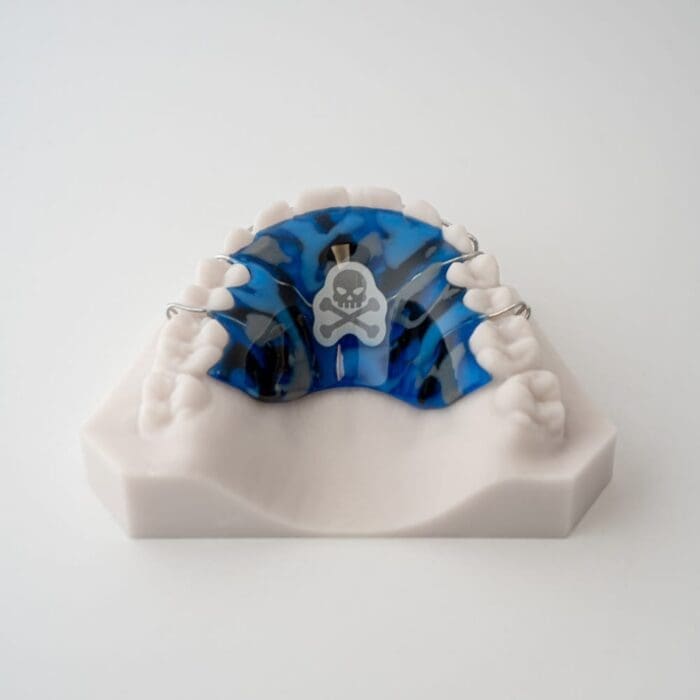 Hawley with Arrow Clasps | ODL Orthodontic Labs