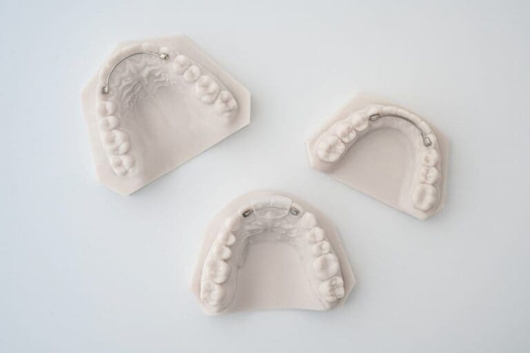 Fixed Lingual Retainers | ODL Orthodontic Labs