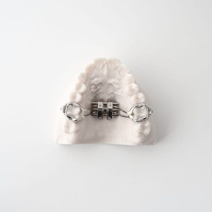 TAD Appliances for Airway Expansion | ODL Orthodontic Labs