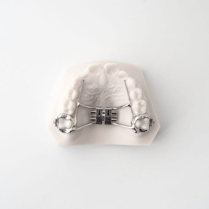 Rapid Palatal Expander | ODL Orthodontic Labs