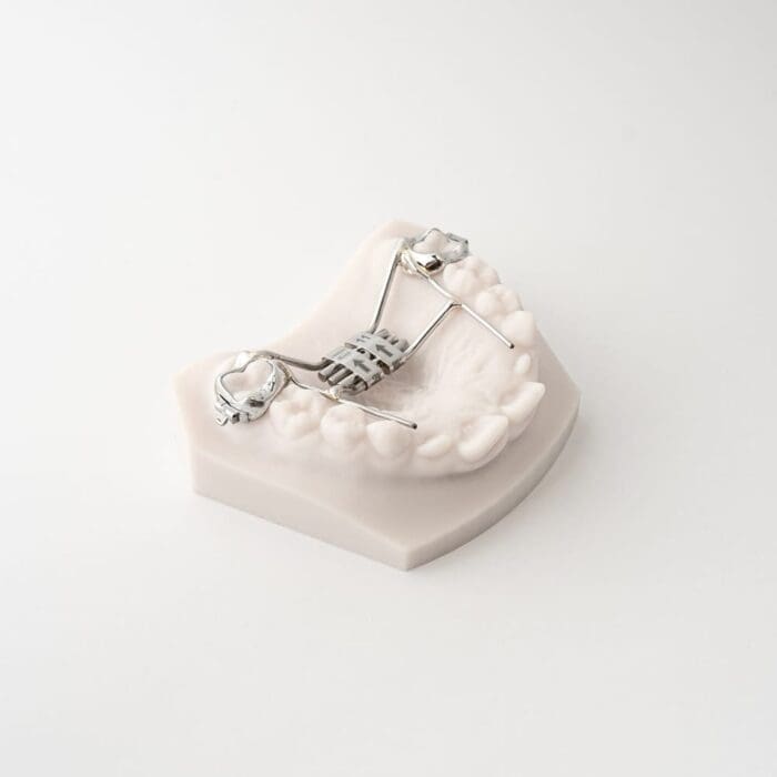 Rapid Palatal Expander | ODL Orthodontic Labs