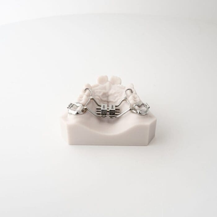 Rapid Palatal Expander | ODL Orthodontic Labs