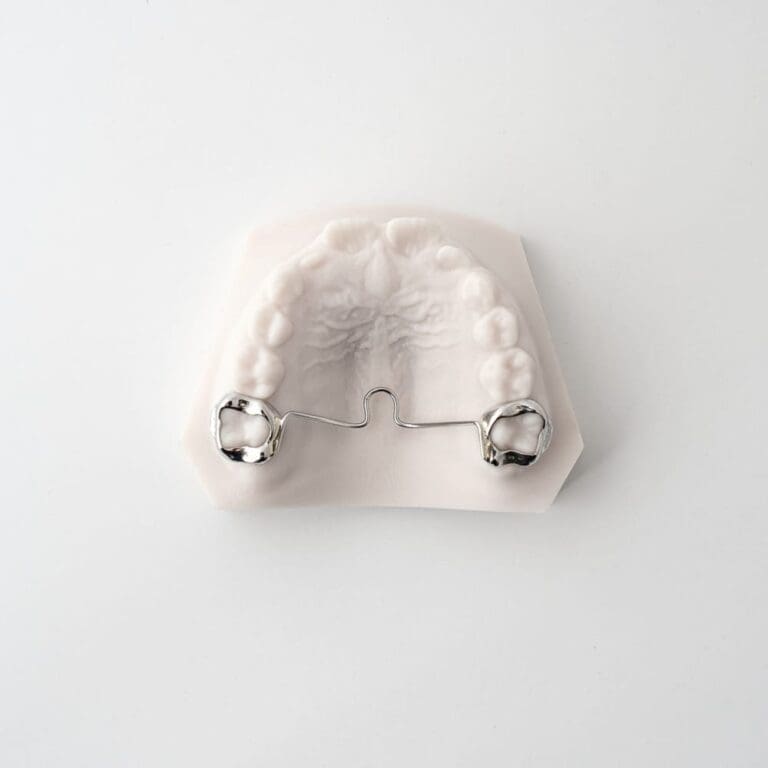 TPA (Transpalatal Arch) | ODL Orthodontic Labs