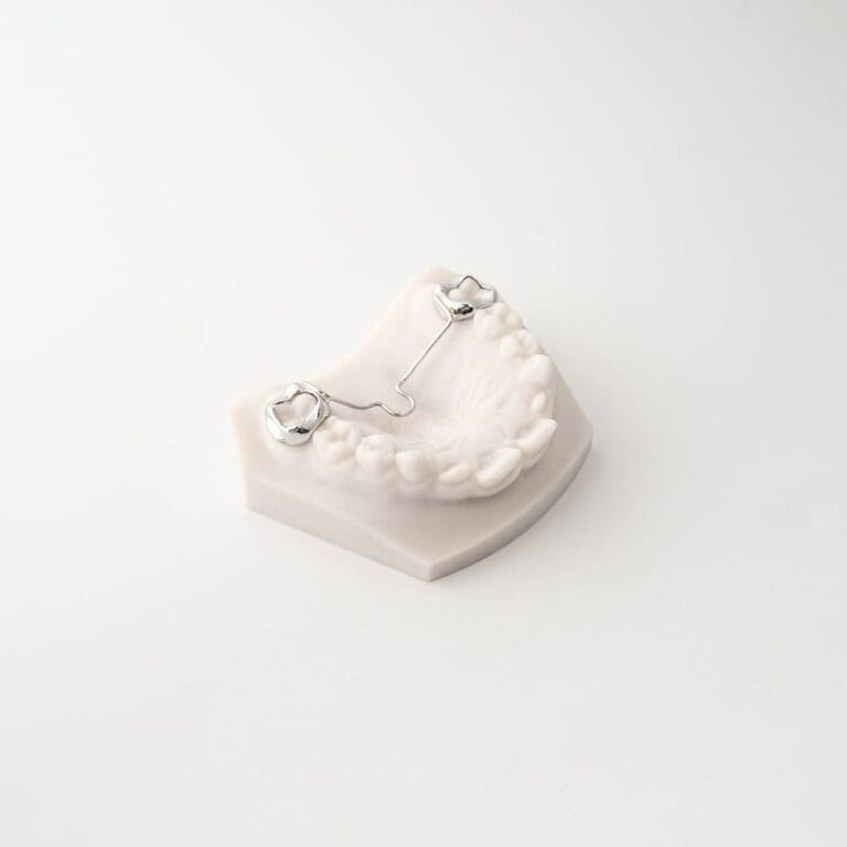 TPA (Transpalatal Arch) | ODL Orthodontic Labs