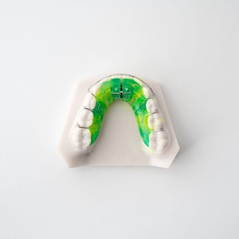 Transverse Appliance (Schwartz Appliance) | ODL Orthodontic Labs