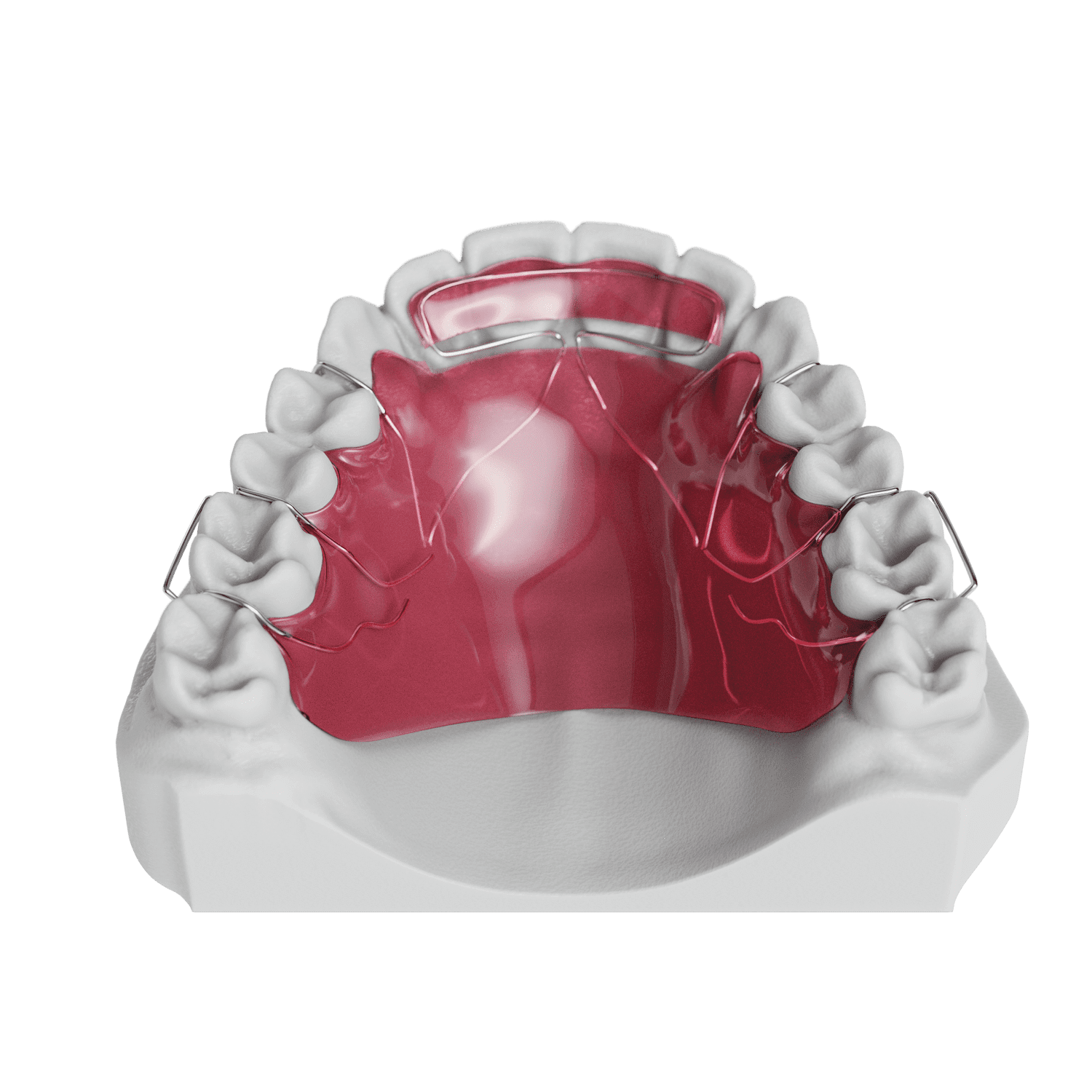 Hawley with Welded Adams Clasps | ODL Orthodontic Labs