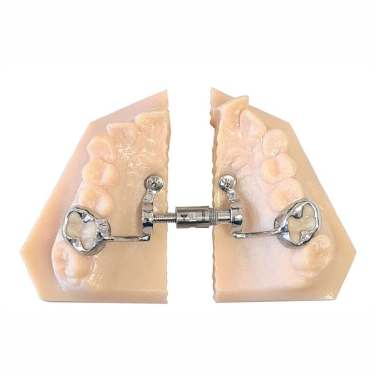 Fan RPE (Rapid Palatal Expander) | ODL Orthodontic Labs