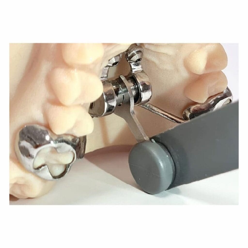 Fan RPE (Rapid Palatal Expander) | ODL Orthodontic Labs