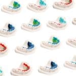 Bionator 1 & 2 | ODL Orthodontic Labs