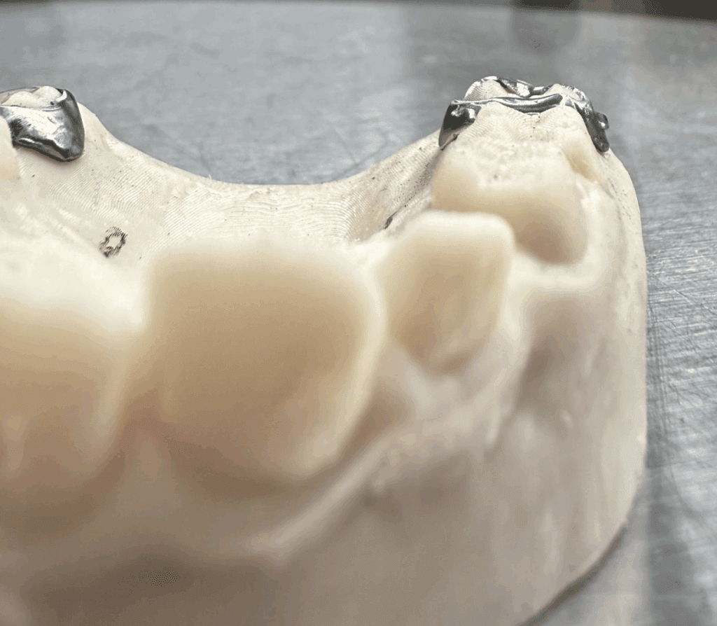 Why More Orthos Are Switching to Laser-Sintered Bands | ODL Orthodontic ...