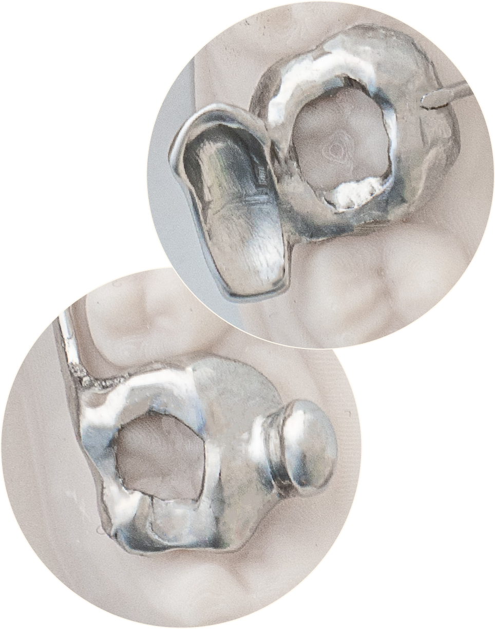 Casper | The Next Generation of Class II Correction | ODL