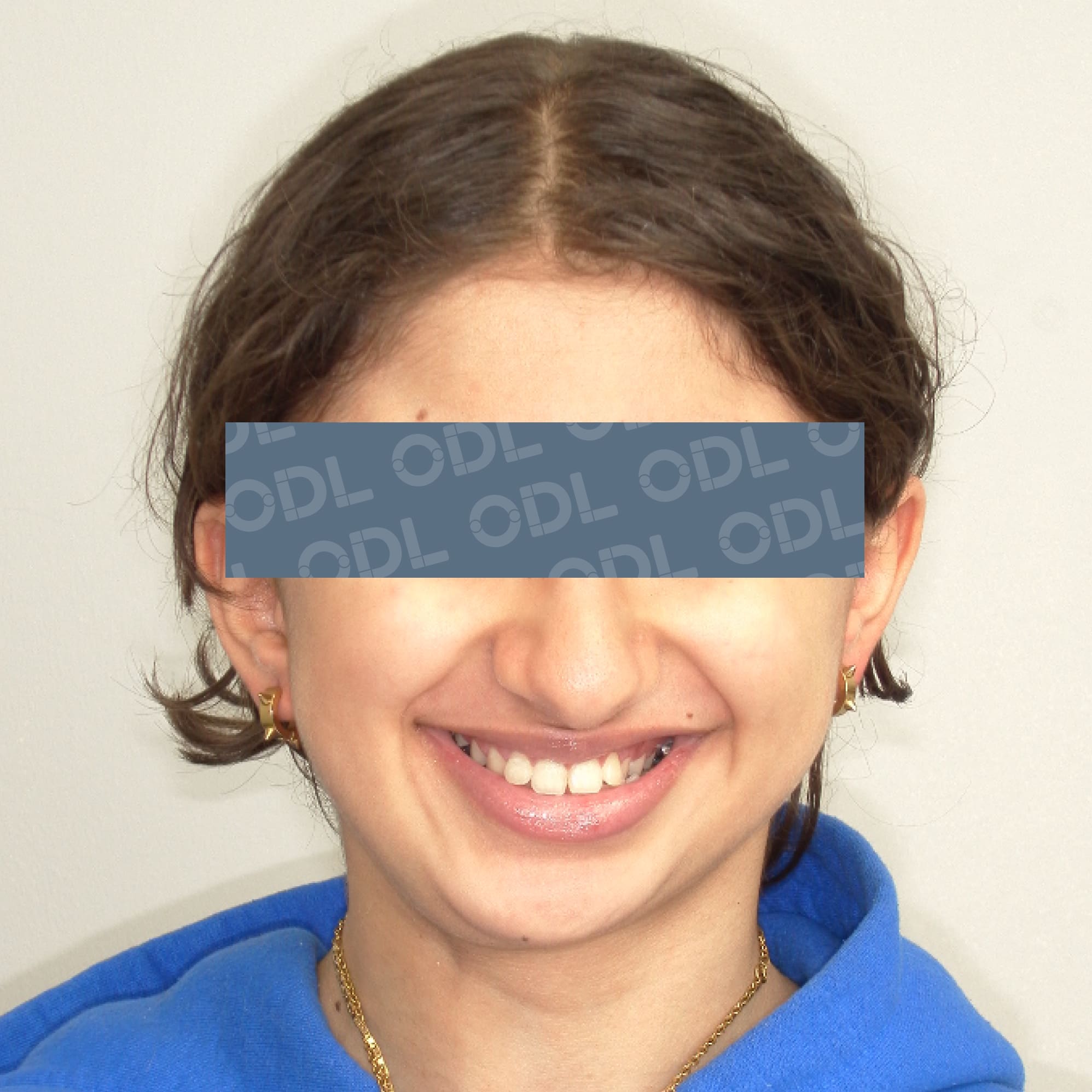 Casper | The Next Generation of Class II Correction | ODL