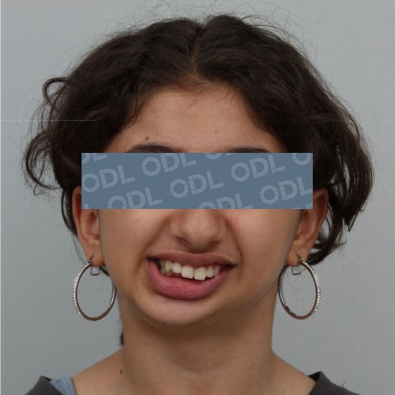 Casper | The Next Generation of Class II Correction | ODL