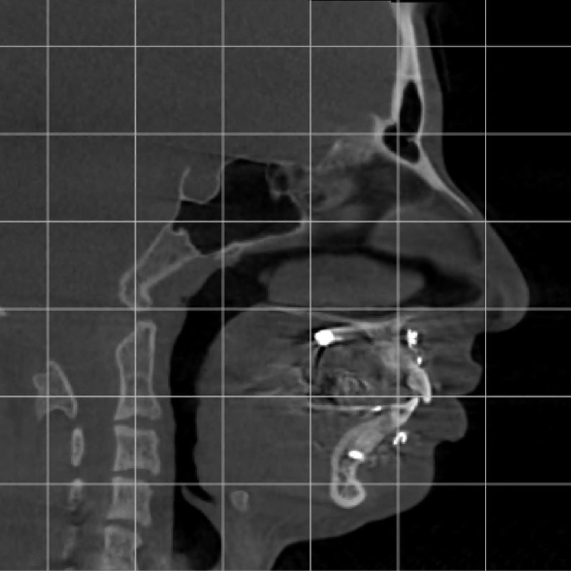 Casper | The Next Generation of Class II Correction | ODL