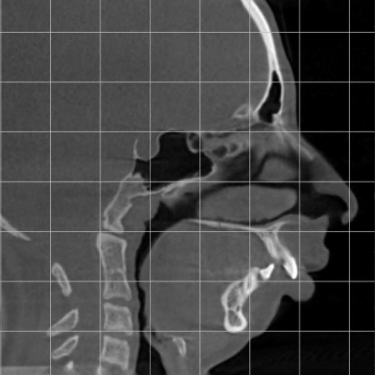 Casper | The Next Generation of Class II Correction | ODL