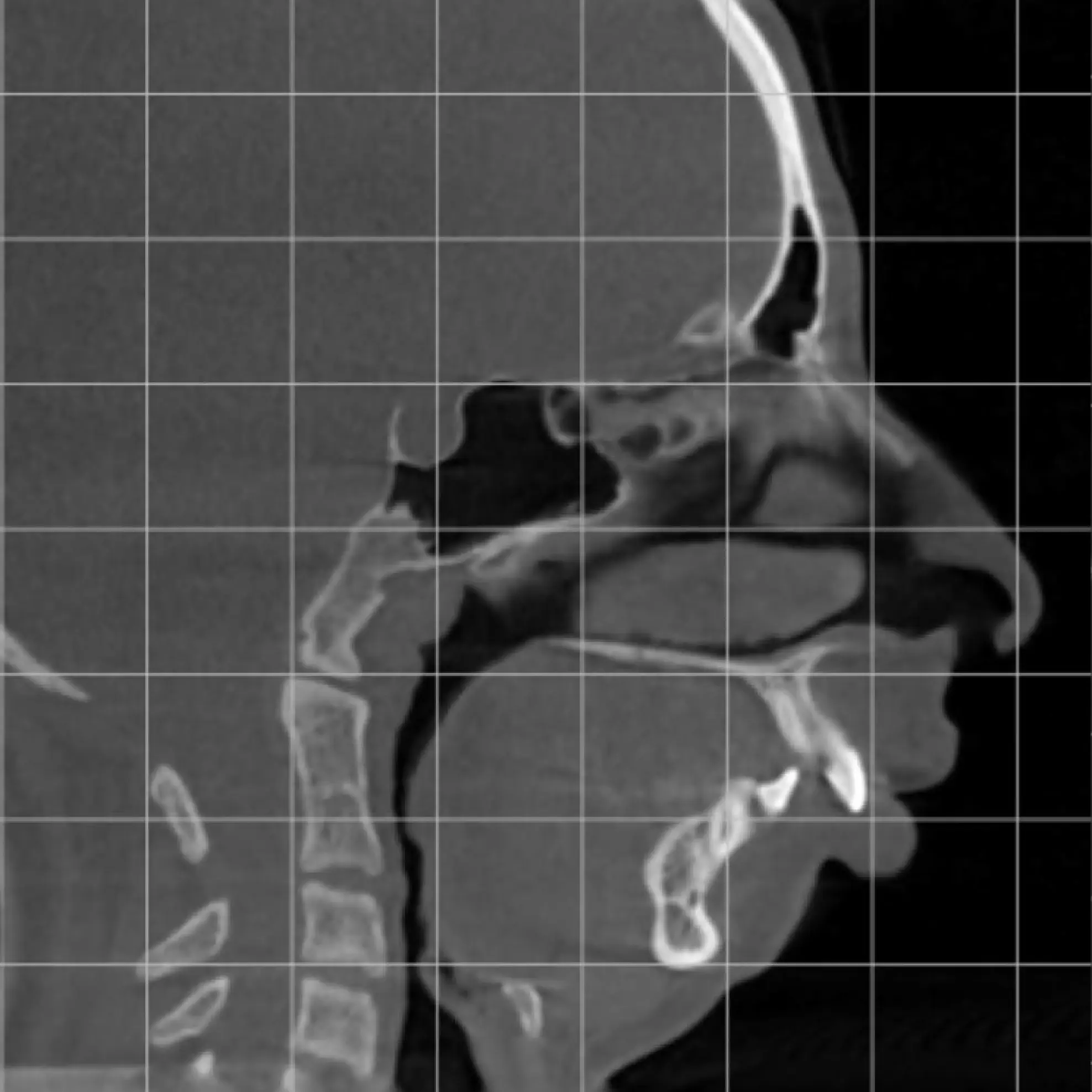 Casper | The Next Generation of Class II Correction | ODL