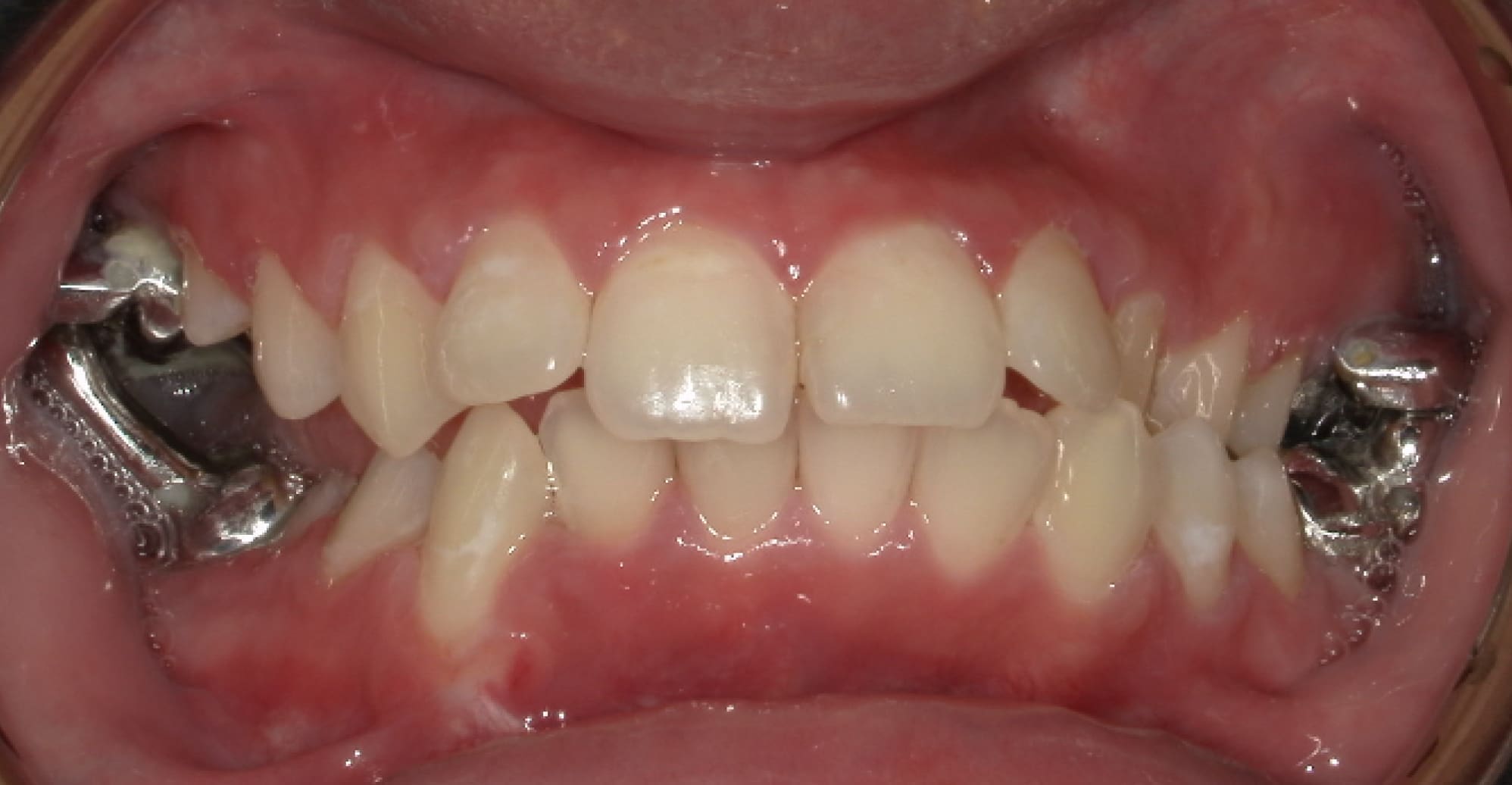 Casper | The Next Generation of Class II Correction | ODL