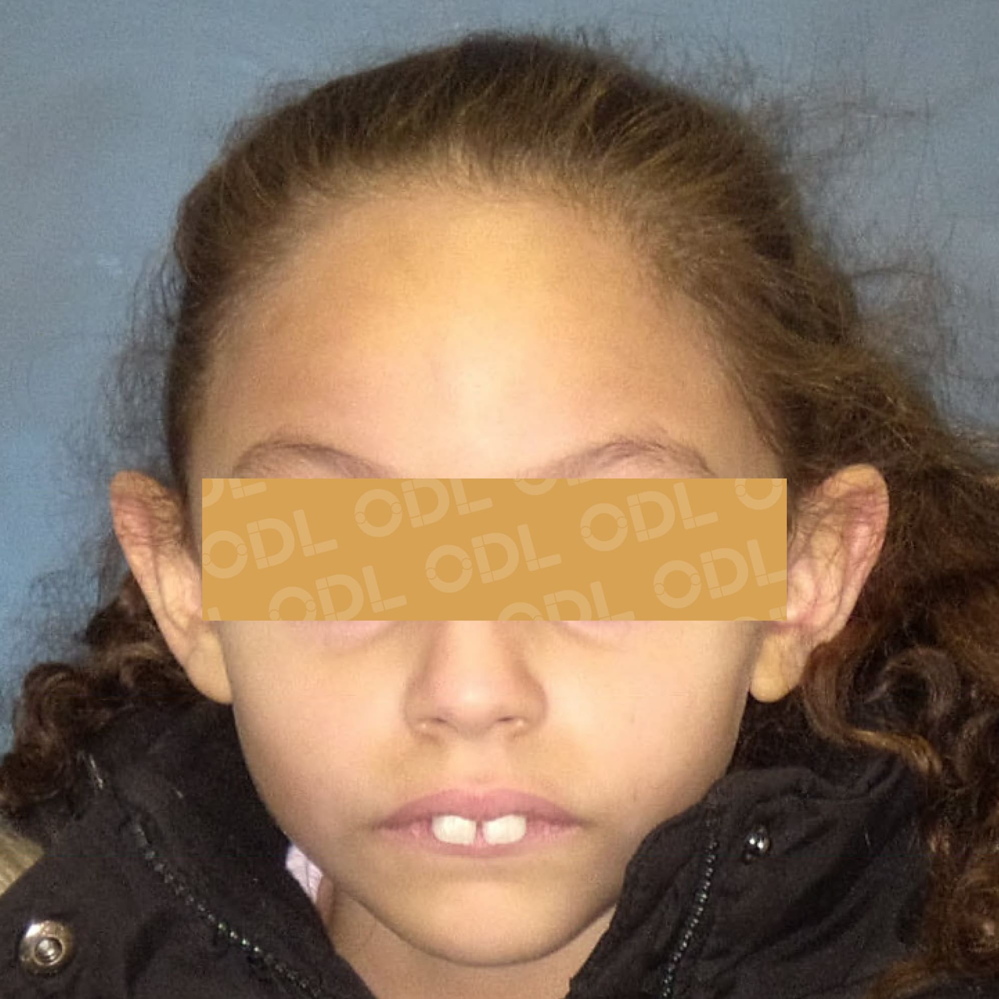 Casper | The Next Generation of Class II Correction | ODL