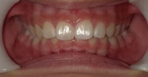 Casper | The Next Generation of Class II Correction | ODL